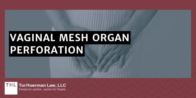Vaginal Mesh Organ Perforation Lawsuit | 2025 Update